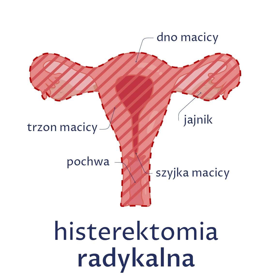 Na czym polega histerektomia? - dr.Herbich